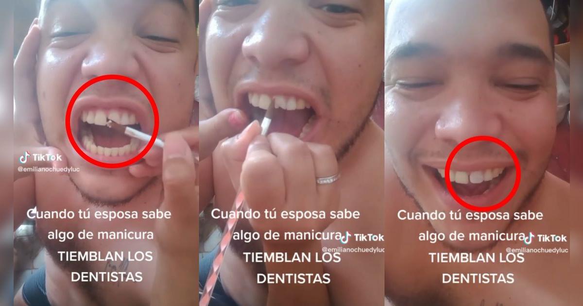 Mujer ‘cura’ con acrílico diente roto de su esposo y se vuelve viral ...