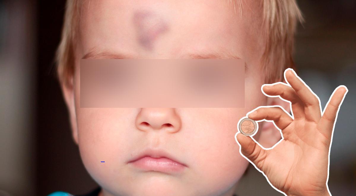 ¿Colocar una moneda sobre un chichón en la cabeza ayuda en algo? Esta ...